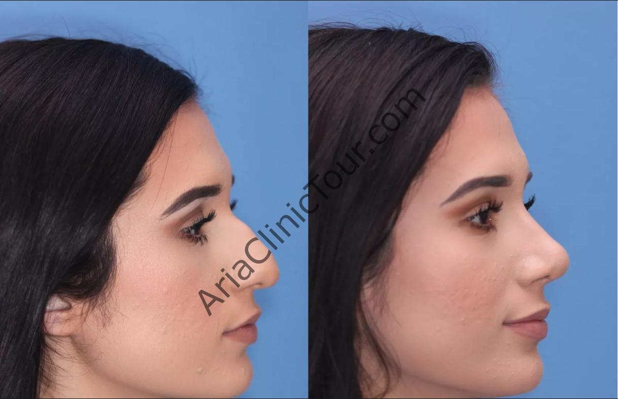 Rhinoplasty – Aria Clinic