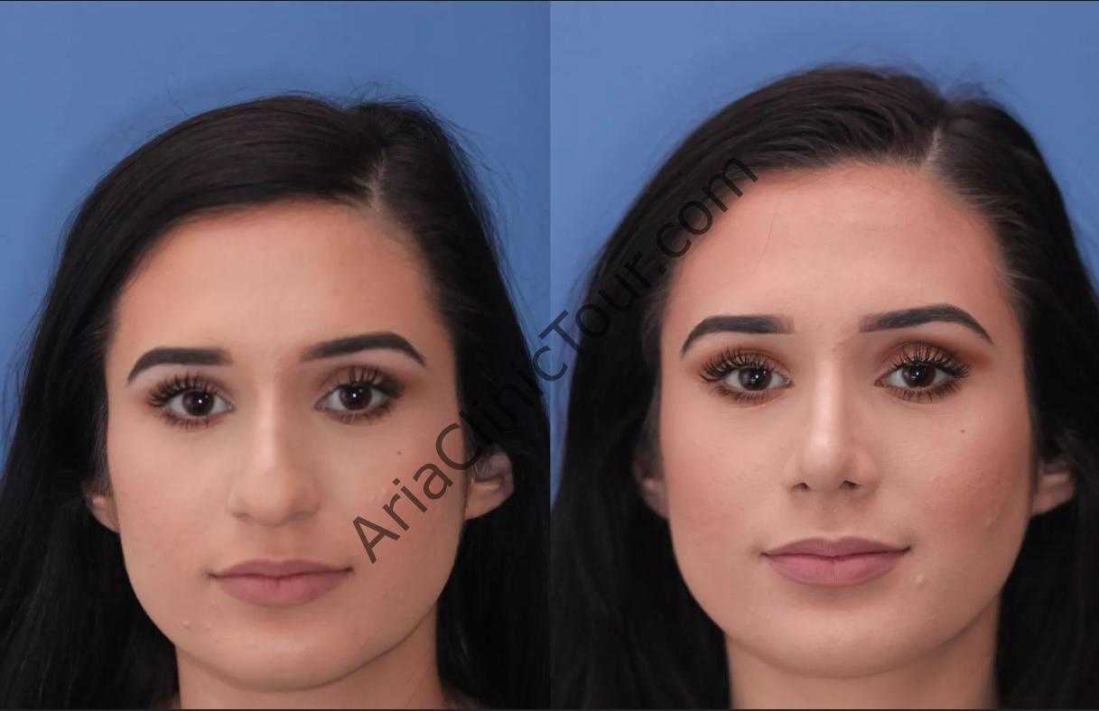 Rhinoplasty – Aria Clinic